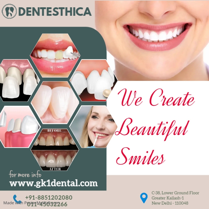 Veneers | PosterMyWall